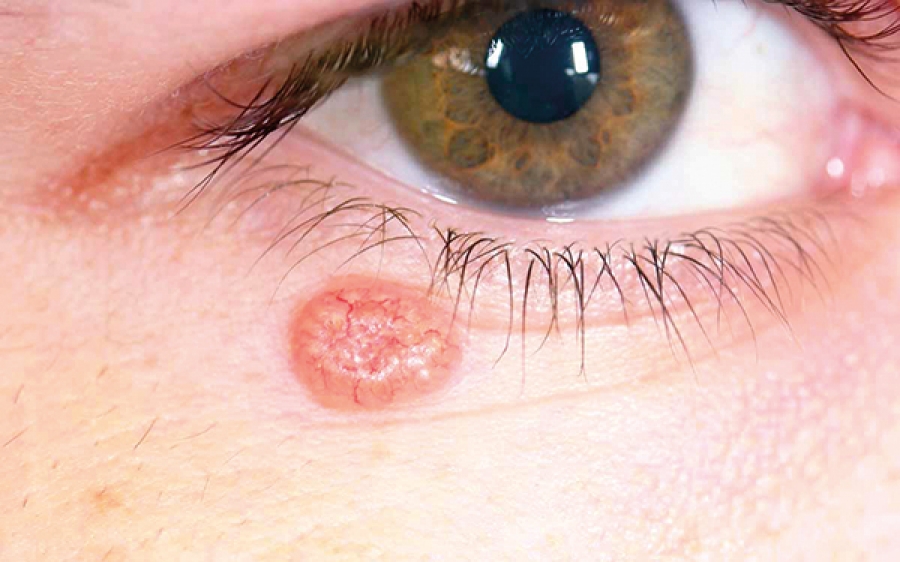 რა არის ბაზალიომა - მკურნალი.გე